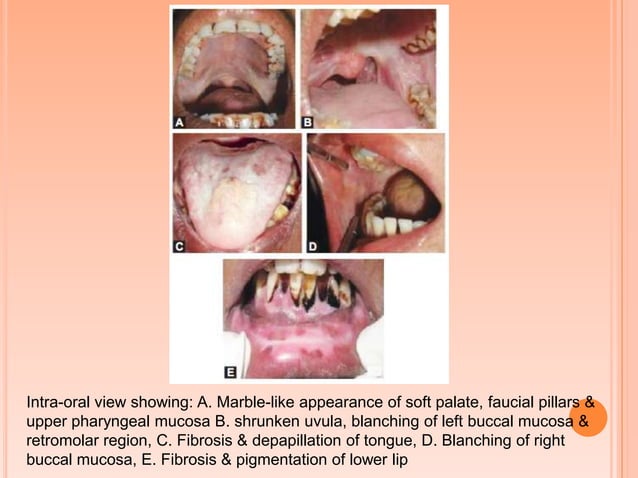 Oral Submucous Fibrosis | PPTX | Dental Health | Diseases and Conditions