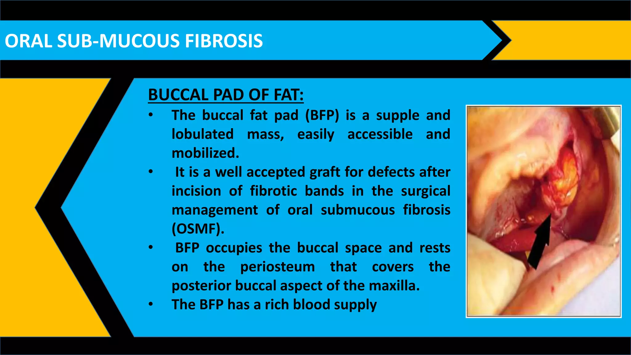 ORAL SUBMUCOUS FIBROSIS (OSMF) | PPTX