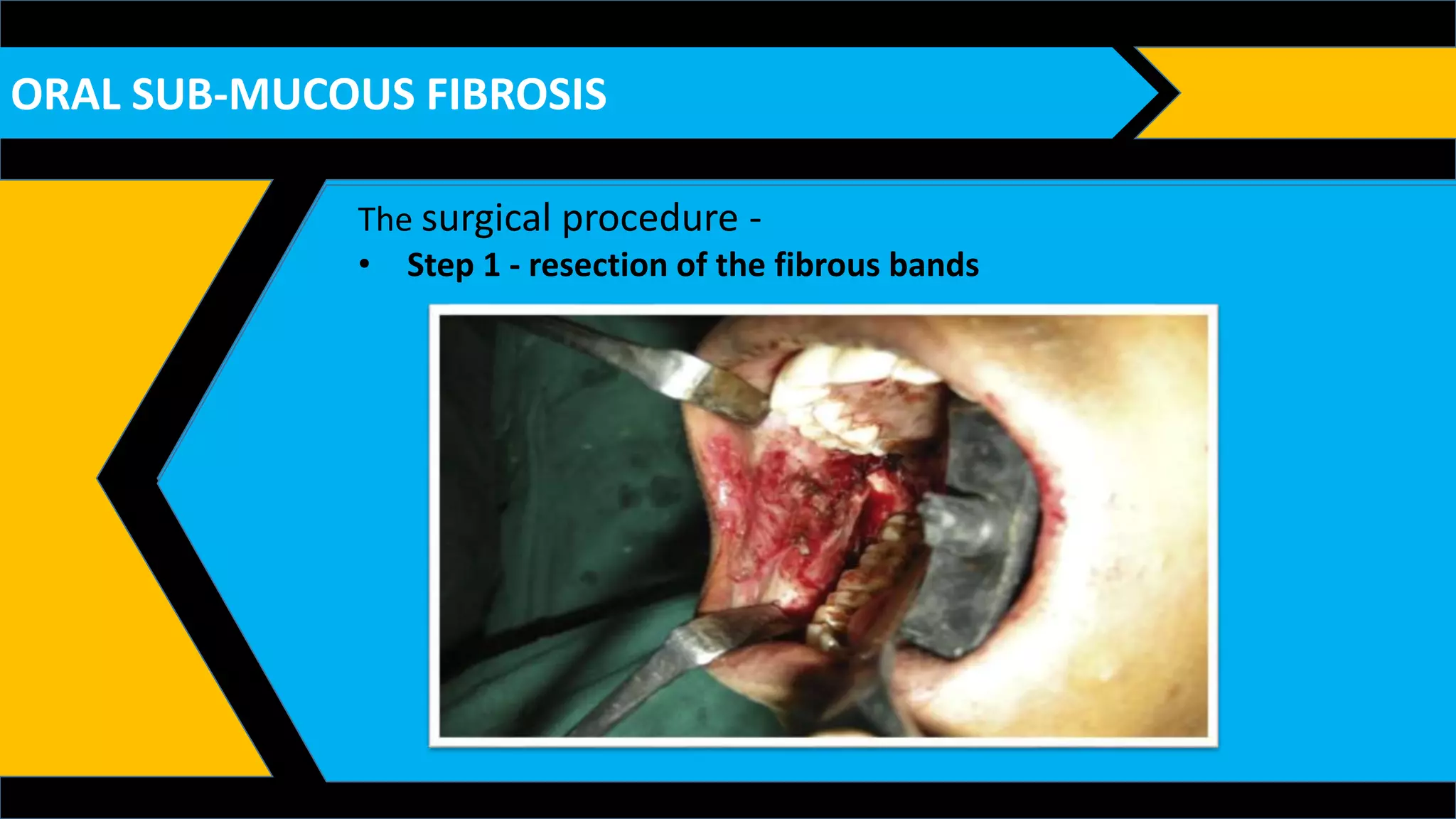ORAL SUBMUCOUS FIBROSIS (OSMF) | PPTX