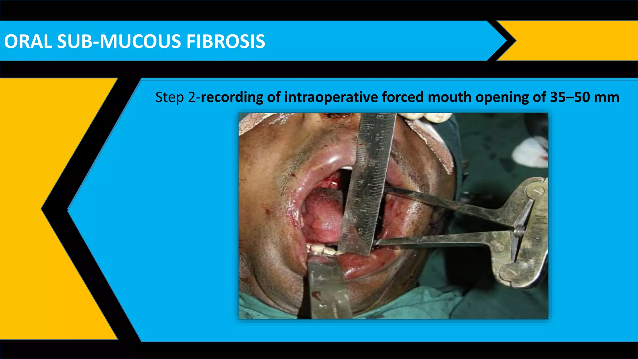 ORAL SUBMUCOUS FIBROSIS (OSMF) | PPTX