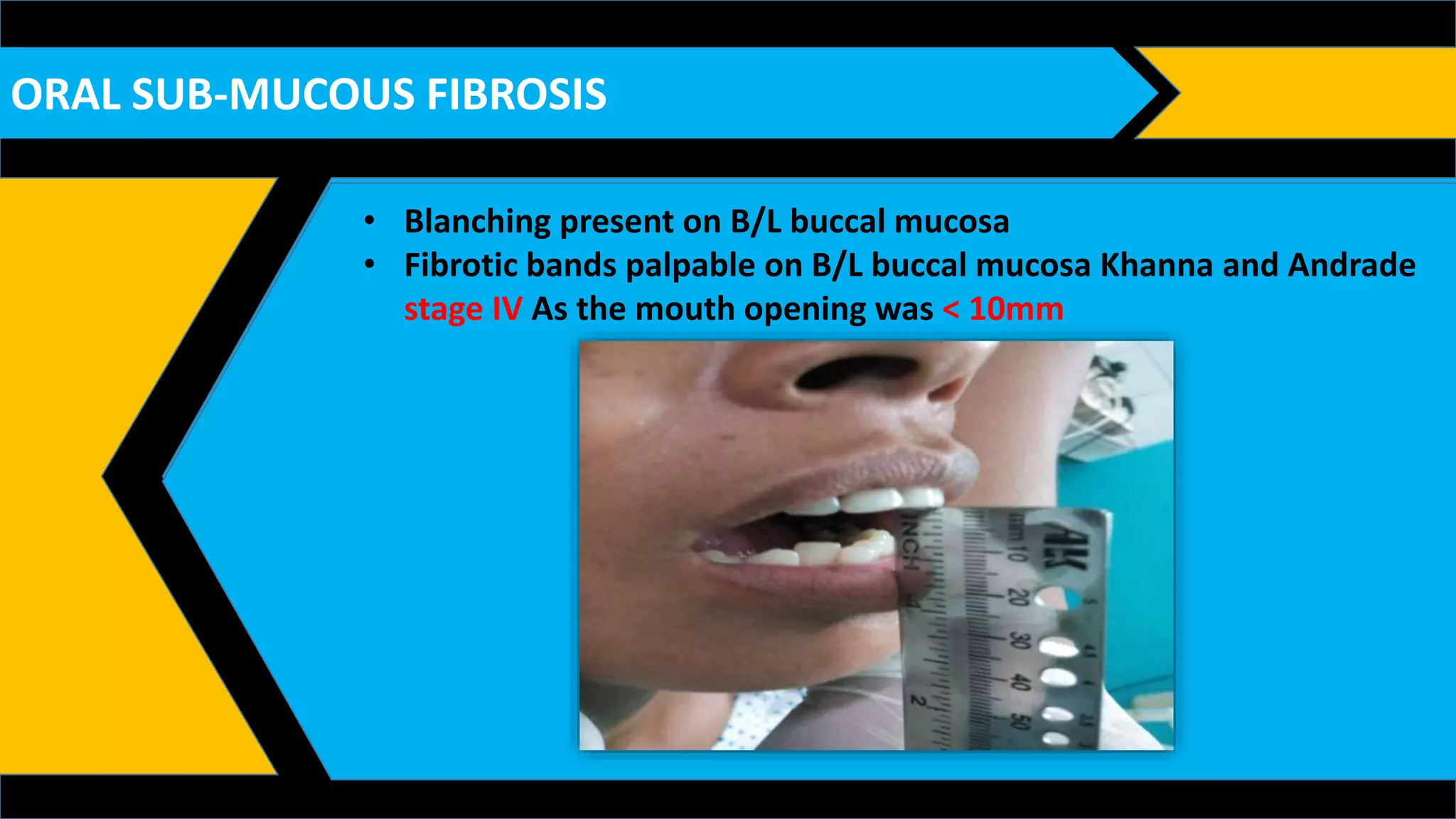ORAL SUBMUCOUS FIBROSIS (OSMF) | PPTX