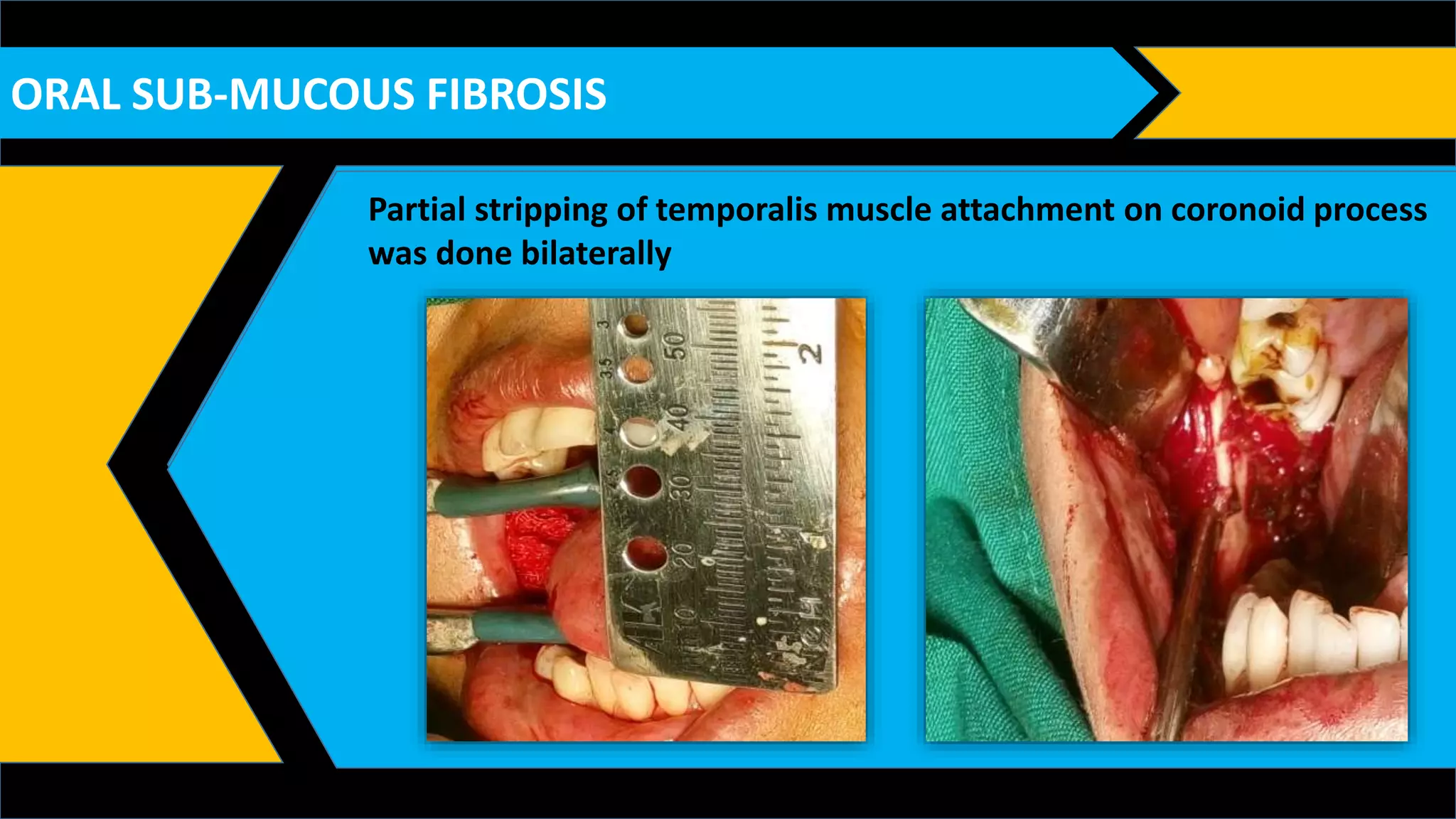 ORAL SUBMUCOUS FIBROSIS (OSMF) | PPTX