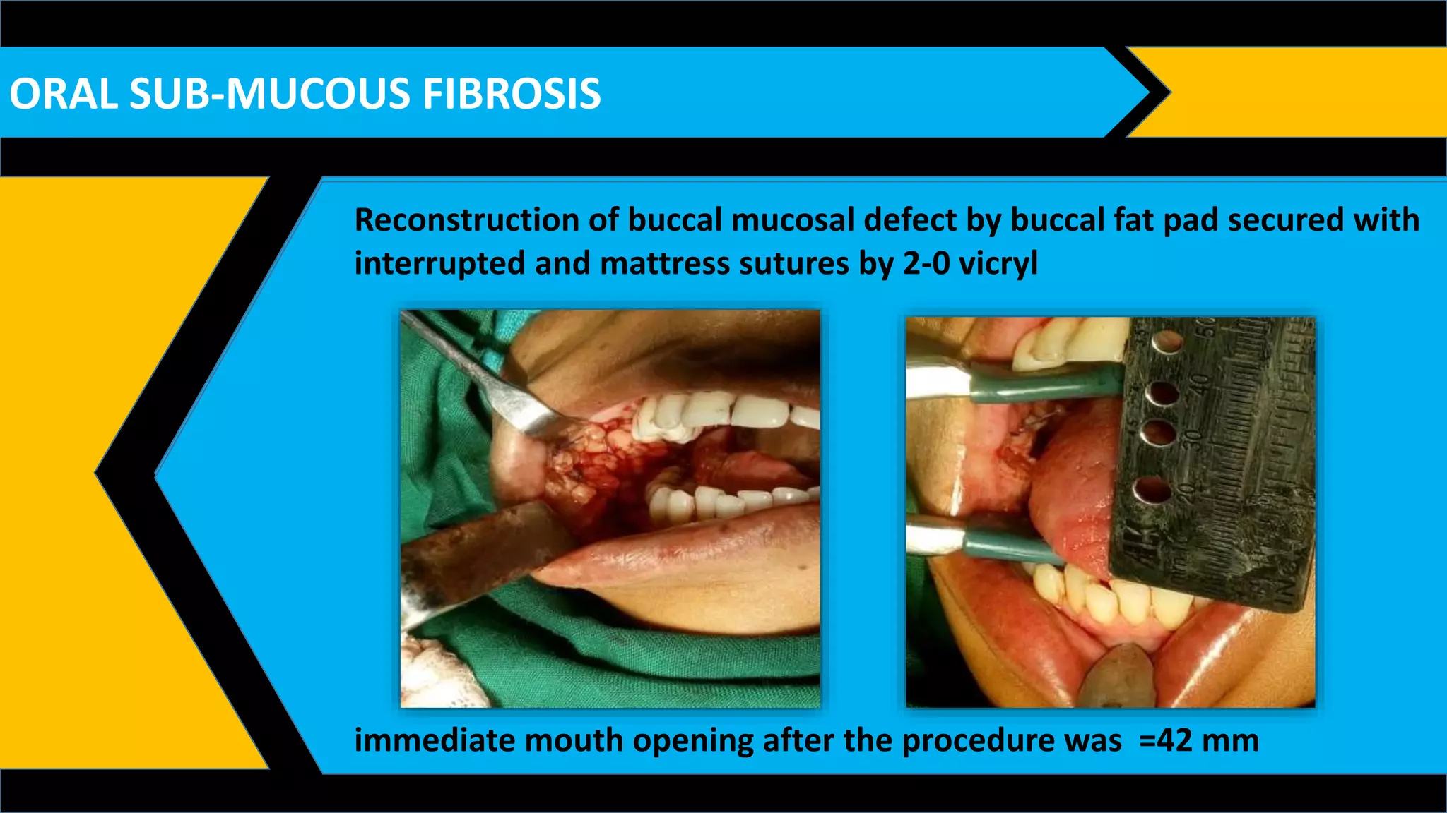 ORAL SUBMUCOUS FIBROSIS (OSMF) | PPTX