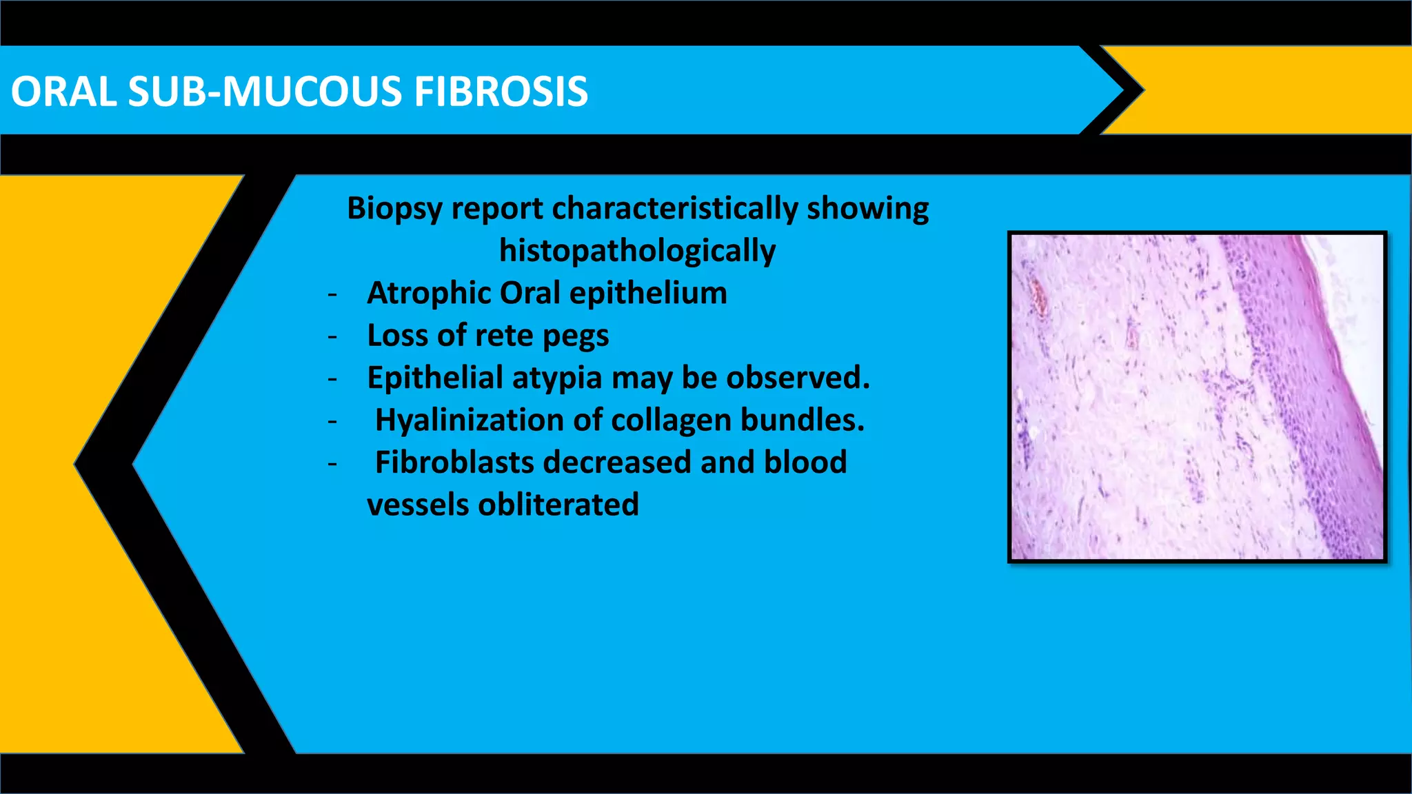 ORAL SUBMUCOUS FIBROSIS (OSMF) | PPTX