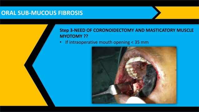 ORAL SUBMUCOUS FIBROSIS (OSMF) | PPTX | Ear, Nose and Throat Conditions | Diseases and Conditions