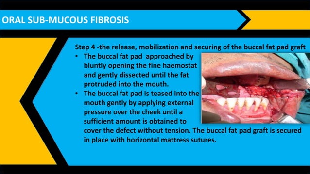 ORAL SUBMUCOUS FIBROSIS (OSMF) | PPTX | Ear, Nose and Throat Conditions ...