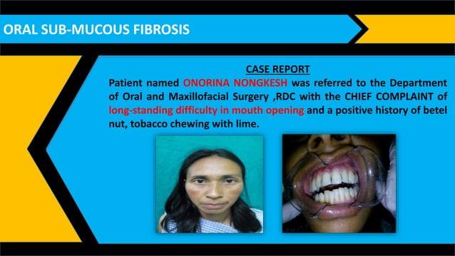 ORAL SUBMUCOUS FIBROSIS (OSMF) | PPTX | Ear, Nose and Throat Conditions | Diseases and Conditions