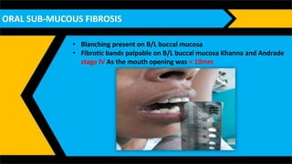 ORAL SUBMUCOUS FIBROSIS (OSMF) | PPTX
