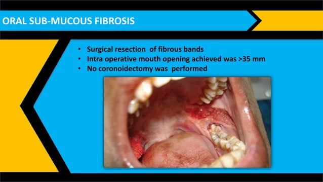 ORAL SUBMUCOUS FIBROSIS (OSMF) | PPTX | Ear, Nose and Throat Conditions | Diseases and Conditions