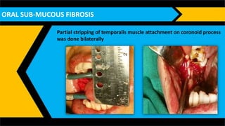 ORAL SUBMUCOUS FIBROSIS (OSMF) | PPTX