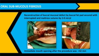 ORAL SUBMUCOUS FIBROSIS (OSMF) | PPTX