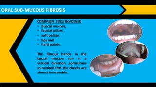 ORAL SUBMUCOUS FIBROSIS (OSMF) | PPTX