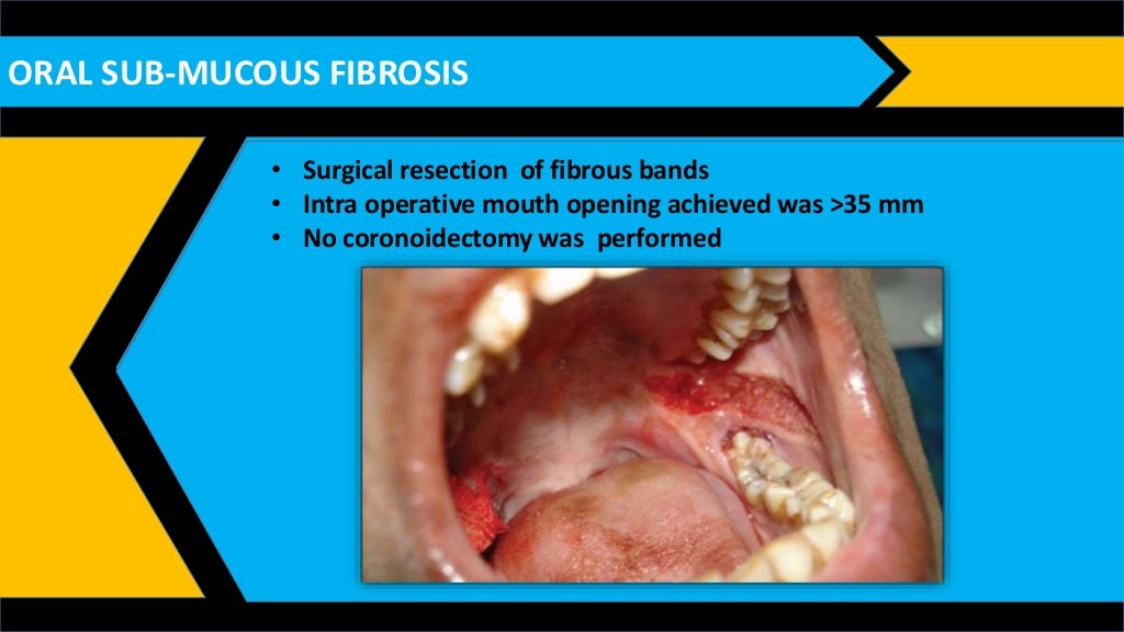 ORAL SUBMUCOUS FIBROSIS (OSMF)
