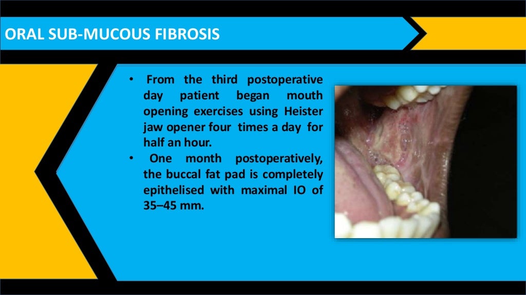 ORAL SUBMUCOUS FIBROSIS (OSMF)