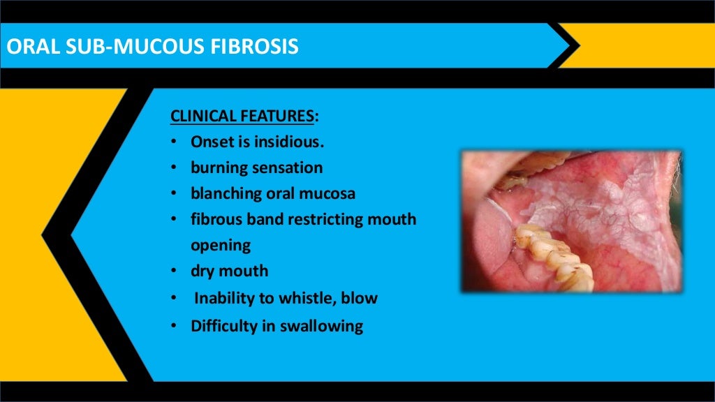 ORAL SUBMUCOUS FIBROSIS (OSMF)