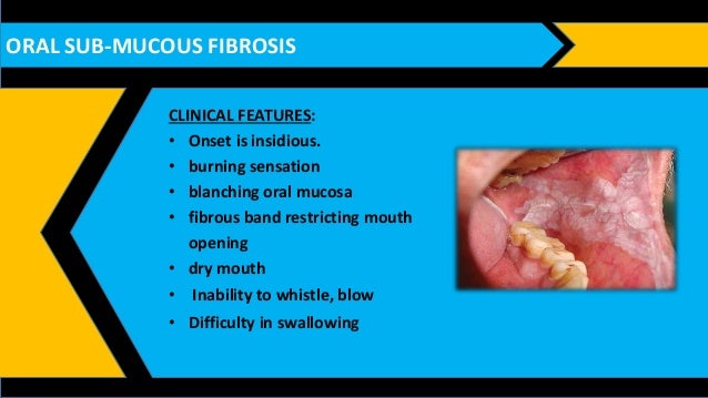 ORAL SUBMUCOUS FIBROSIS (OSMF)