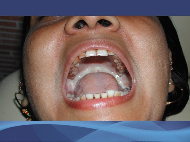 Oral Submucous Fibrosis