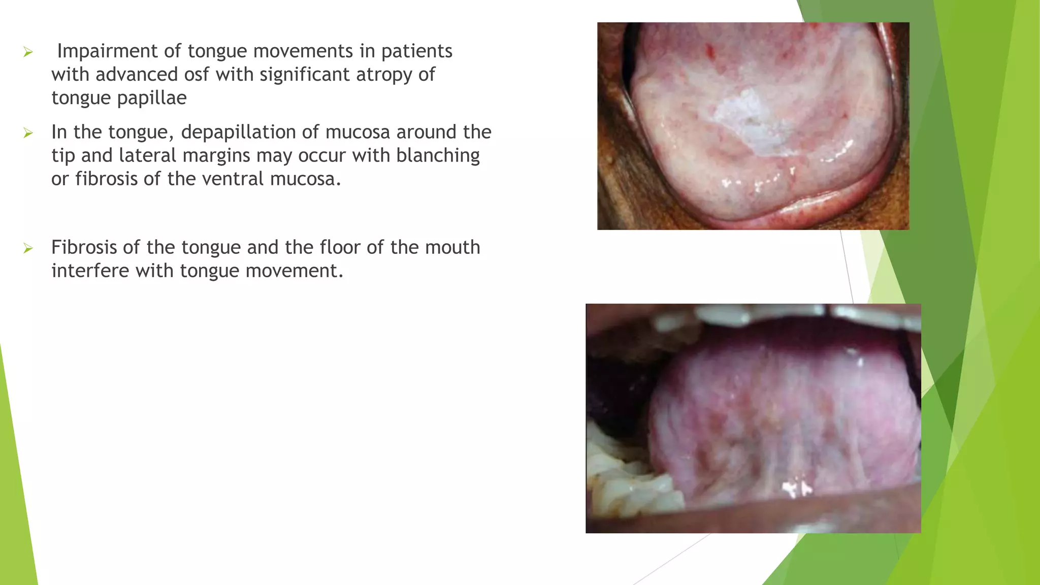 oral submucous fibrosis | PPTX