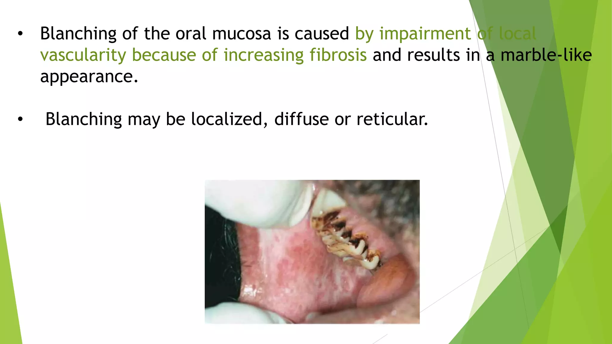 oral submucous fibrosis | PPTX