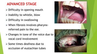 oral submucous fibrosis | PPTX