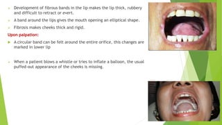 oral submucous fibrosis | PPTX