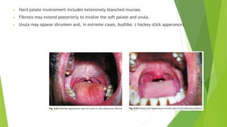 oral submucous fibrosis | PPTX