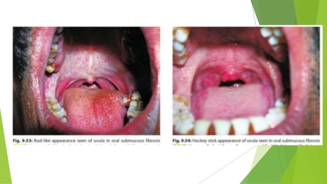oral submucous fibrosis