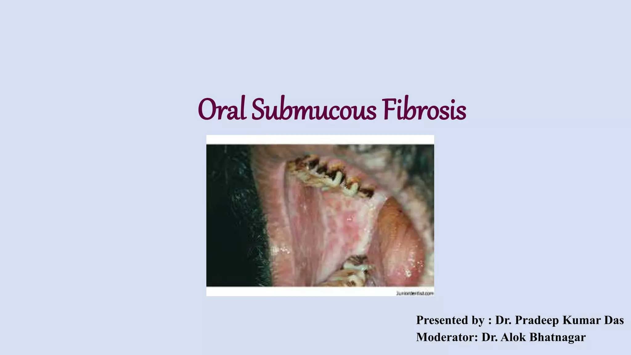 Oral Submucous Fibrosis: Causes, Symptoms, and Treatment | PPT