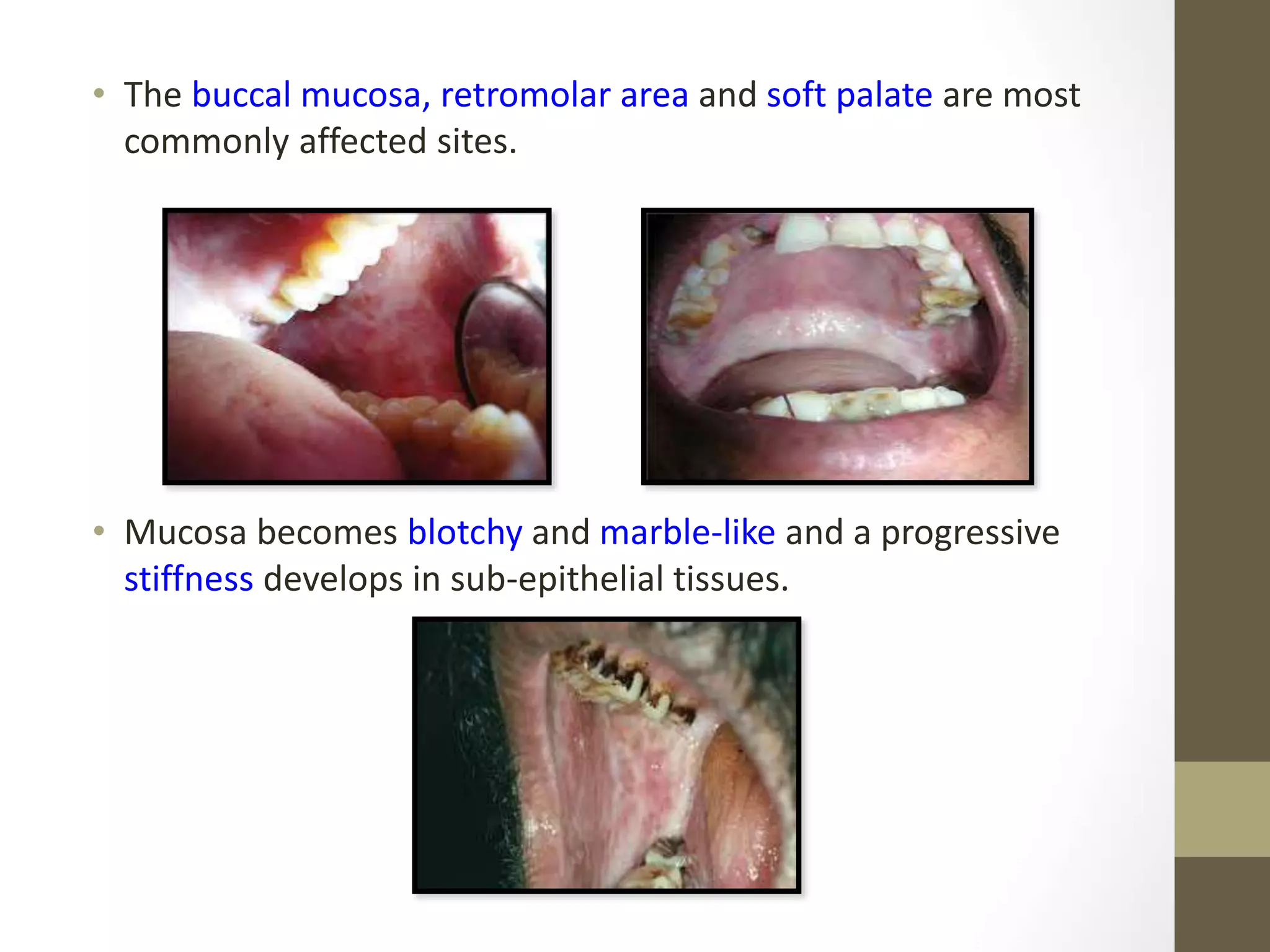 oral submucous fibrosis ppt