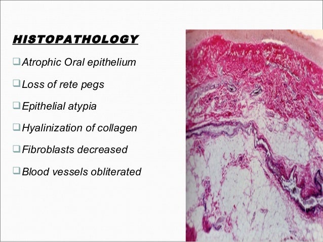 Oral Submucous Fibrosis Histopathology