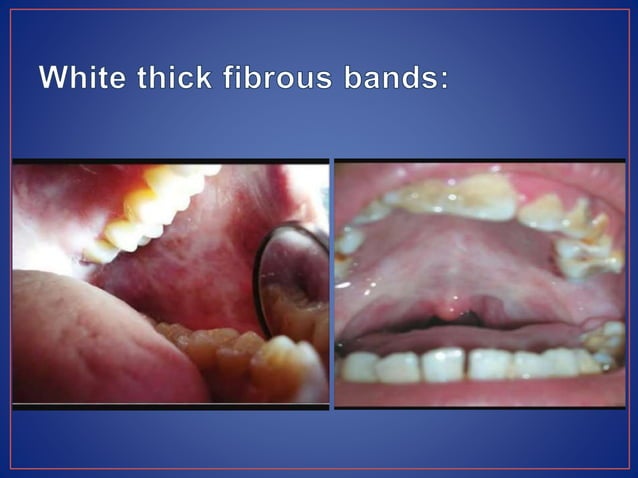 Oral submucous fibrosis | PPTX | Ear, Nose and Throat Conditions ...