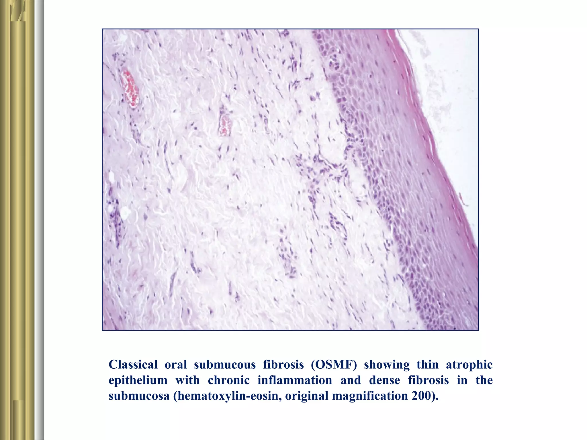 ORAL SUBMUCOUS FIBROSIS- PPT | PPT