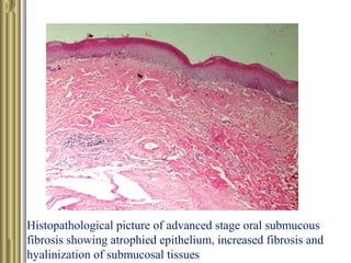 Oral Submucous Fibrosis Histopathology