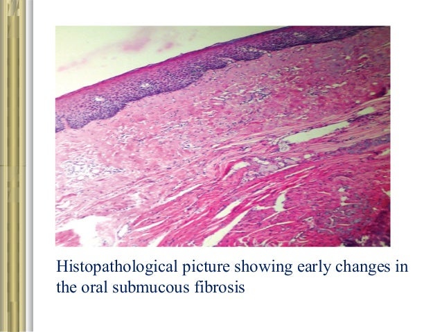 Oral Submucous Fibrosis Histopathology