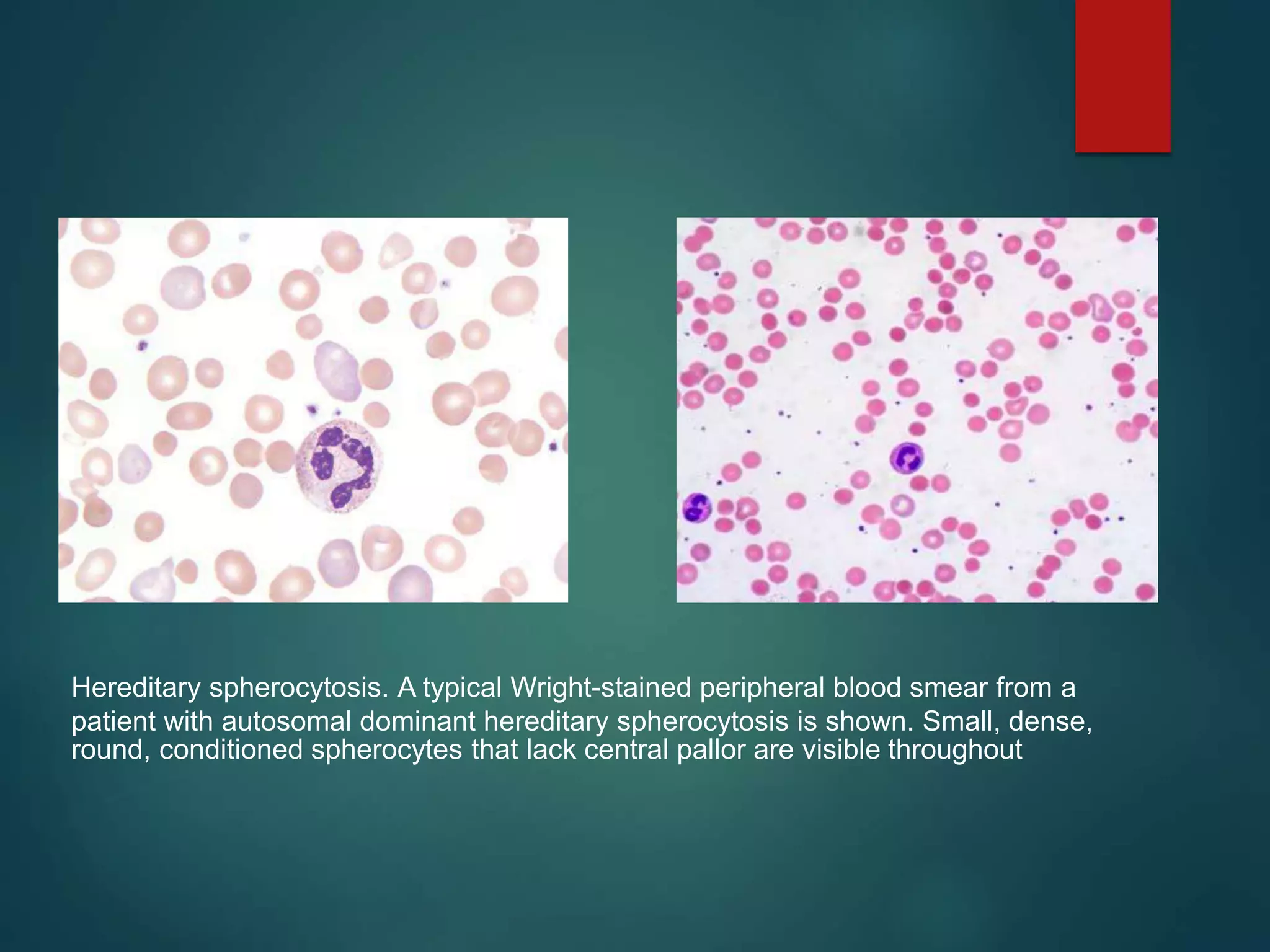 Osmotic fragility & rbc membrane defects 050916 | PPTX