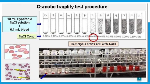Osmotic Fragility Test | PPTX
