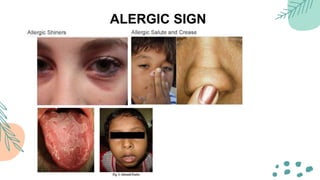 ppt rhinitis alergi pada pasien dan kasusnya | PPTX