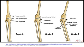 Dr.Rama Kartheek presentation in OSSAP con for Patho Anatomy of osteoarthritis | PPT