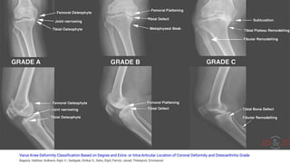 Dr.Rama Kartheek presentation in OSSAP con for Patho Anatomy of osteoarthritis | PPT