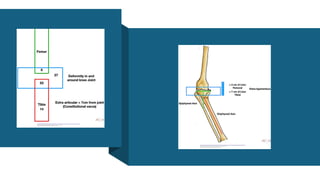 Dr.Rama Kartheek presentation in OSSAP con for Patho Anatomy of osteoarthritis | PPT