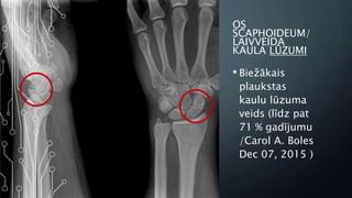 Os scaphoideum;beneta lūzums | PPTX