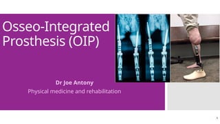 Osseo-Integrated Prosthesis for amputation | PPT