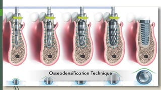 Osseodensification | PPTX