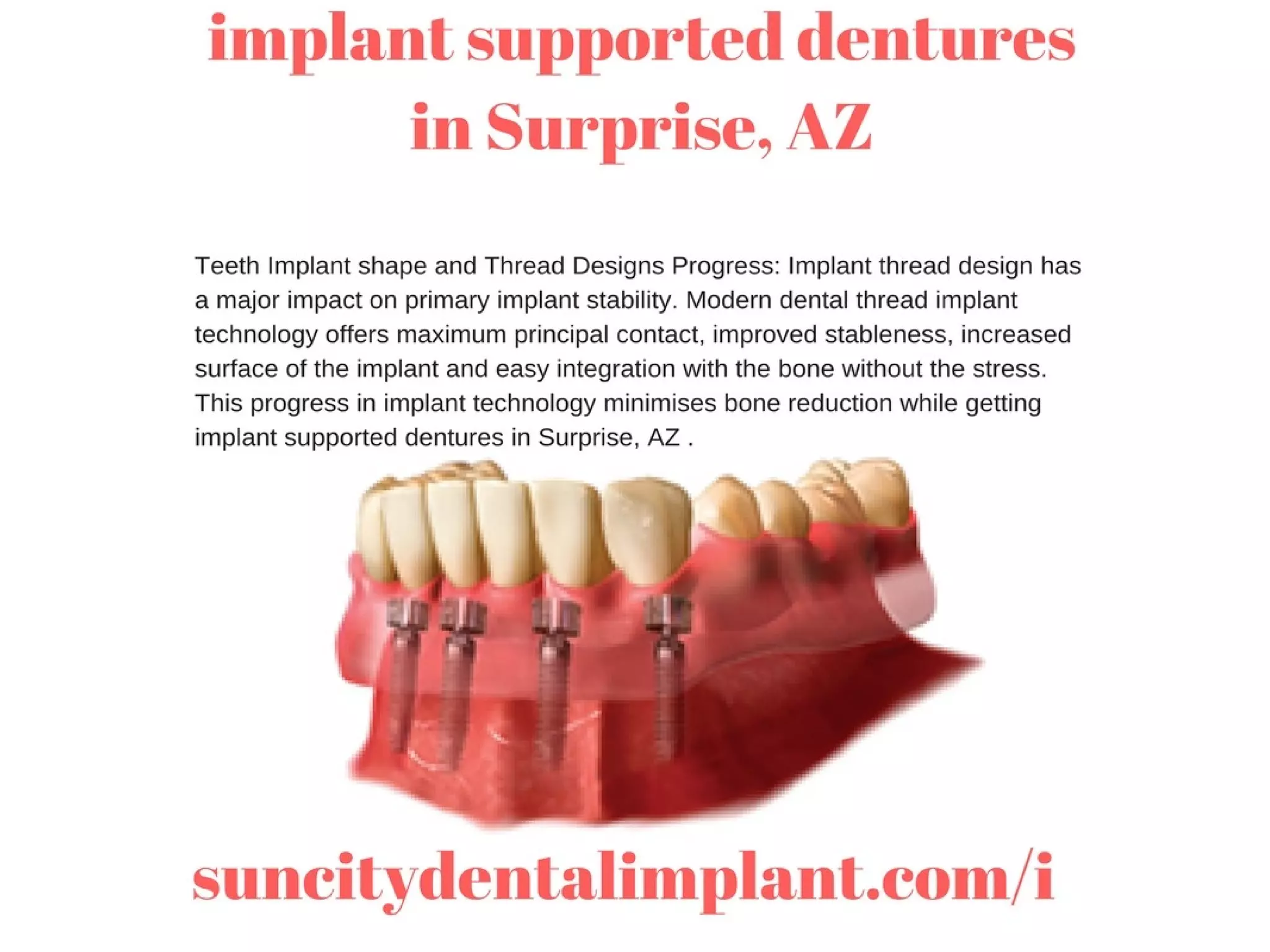 Osseointegrated implants | PPT