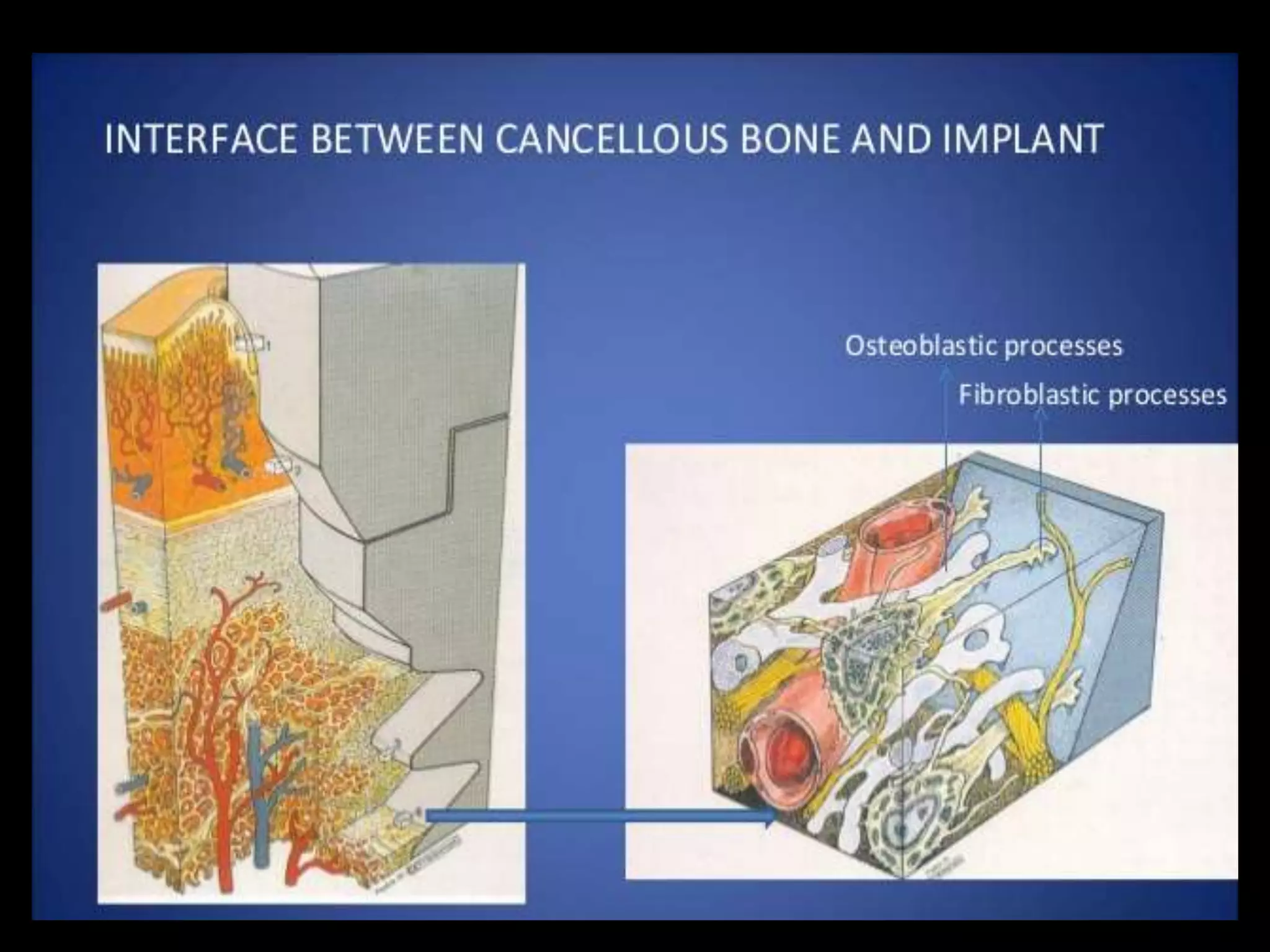 "OSSEOINTEGRATION" | PPTX