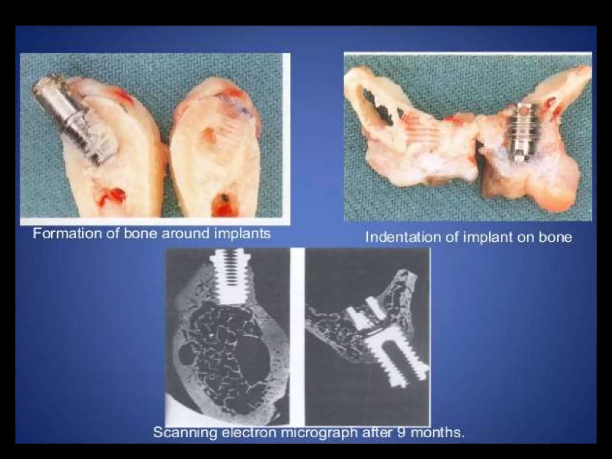 "OSSEOINTEGRATION" | PPTX