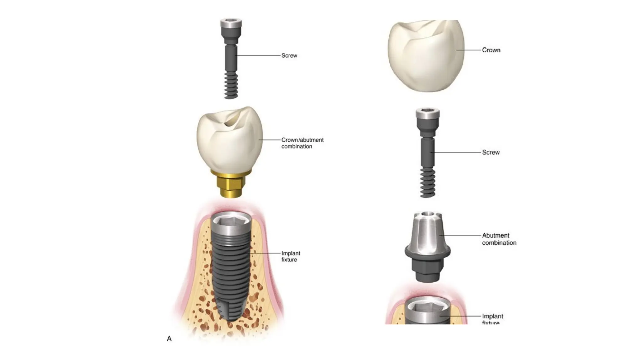 good Osseointegration during implant.ppt