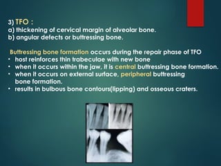 Periodontal Bone Loss and Patterns of Bone Destruction | PPTX