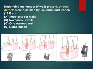 Periodontal Bone Loss and Patterns of Bone Destruction | PPTX