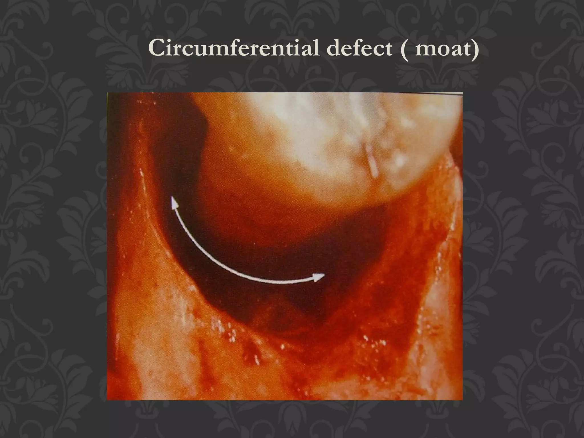 Osseous surgery | PPT